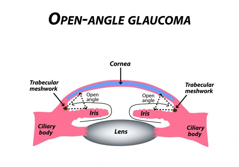 Selective Laser Trabeculoplasty | Cohlmia Eye Center | Wichita